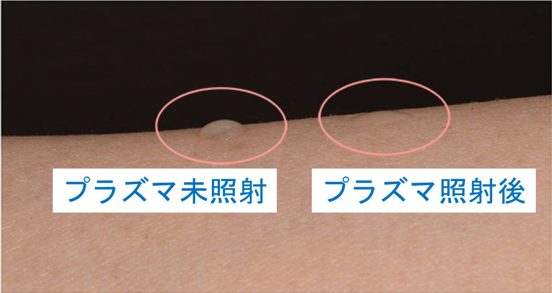 NeoGen EVO（ネオジェン エヴォ）によるプラズマ治療（プラズマフェイシャル） 〜当院オススメの美白・美肌治療〜｜森の宮皮フ科クリニック ...